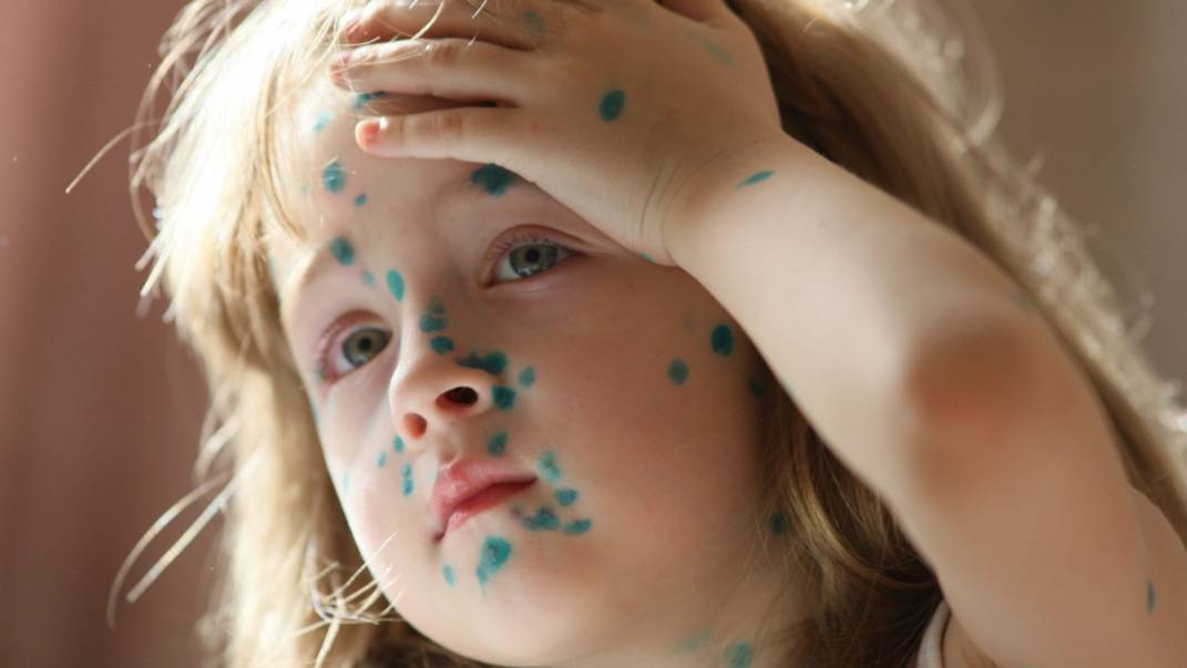 В России стремительно растет заболеваемость ветрянкой