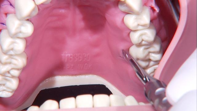 Пластическая хирургия пародонта (9 часть, поднятие расщепленного лоскута, небного)