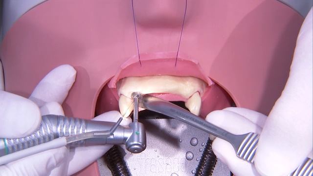 Имплантология (10 часть, профилированная подготовка площадки)