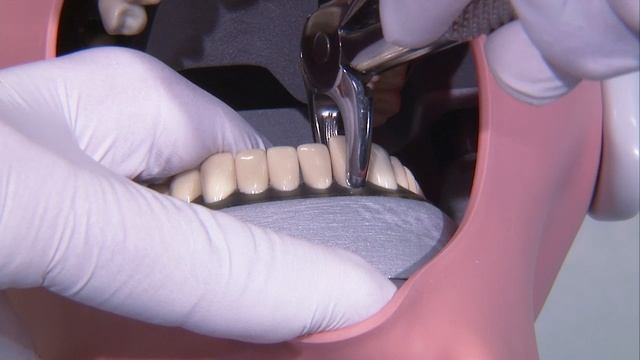 Удаление зуба (9 часть, вывих, удаление зуба щипцами)