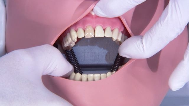 Изготовление временной коронки (10 часть, примерка временной коронки и проверка окклюзии)