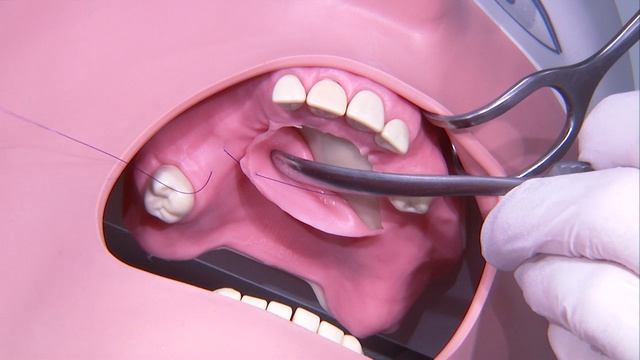 Оперативное удаление ретенированного клыка (3 часть,фиксация,наложение швов для закрепления лоскута)