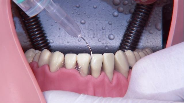 Удаление зубного камня (7 часть, заключительное промывание кармана антисептиками)