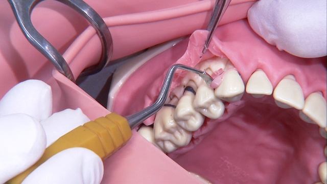 Пародонтальная хирургия (6 часть, удаление воспаленной ткани щеки)