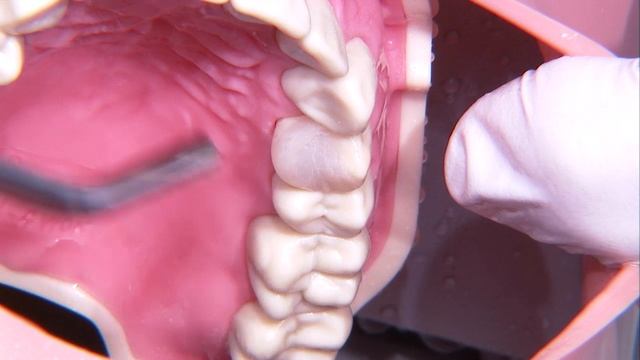 Восстановление культи зуба (17 часть, завершение обработки окклюзионных поверхностей)