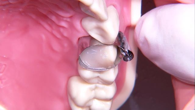 Восстановление культи зуба (15 часть, удаление матрицы и межзубных клиньев)