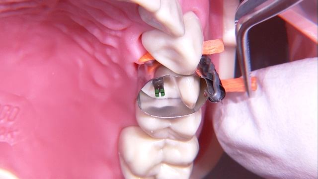 Восстановление культи зуба (10 часть, расклинивание стальной матрицы)