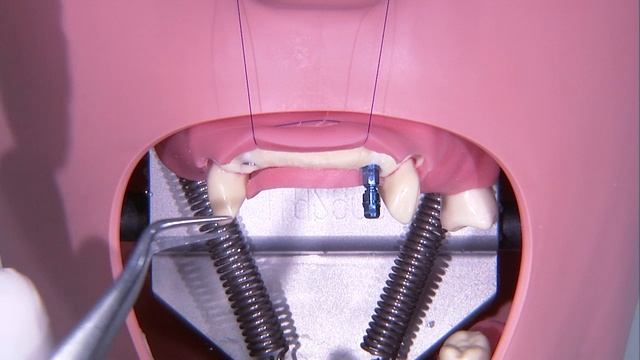 Имплантология (19 часть, удаление компонентов переноса Locksim)