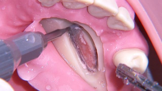 Оперативное удаление ретенированного клыка (5 часть, остеотомия с использованием фрезы Линдеманна)