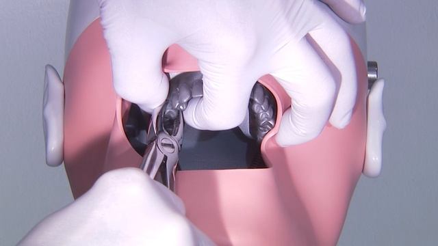 Удаление зуба (3 часть, вывих, удаление зуба щипцами)