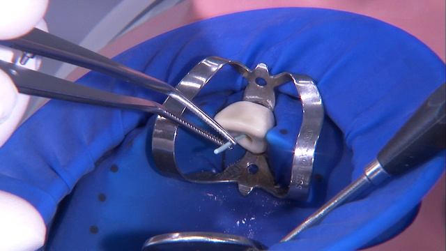 Эндодонтия (8 часть, примерка гуттаперчевого штифта)