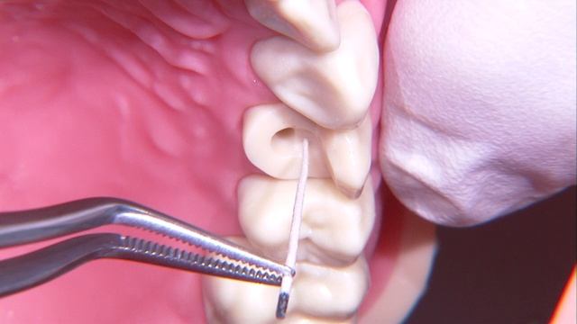 Восстановление культи зуба (6 часть, сушка бумажными штифтами)