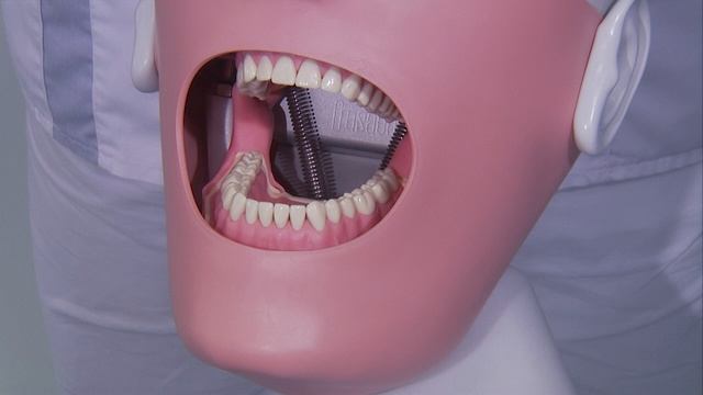 Местная анестезия (2 часть, проводниковая анестезия подбородочного нерва на нижней челюсти)