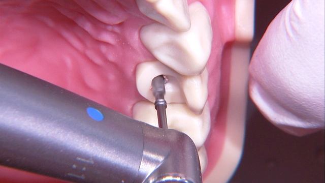 Восстановление культи зуба (2 часть, расширение канала)