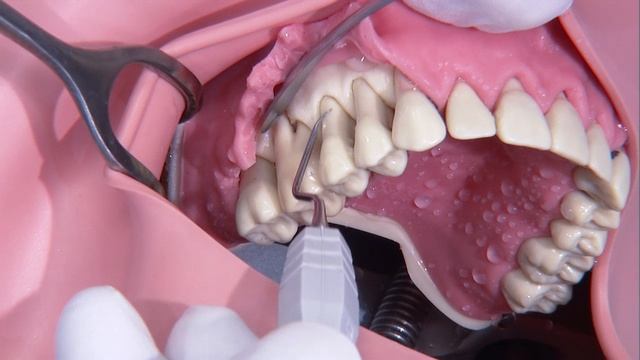 Пародонтальная хирургия (8 часть, кюретаж)