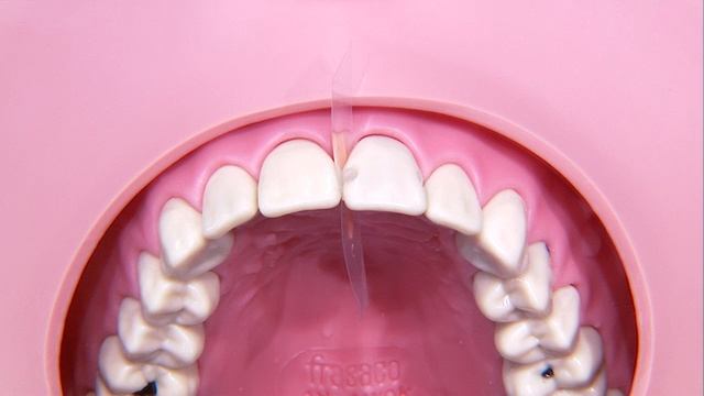 Реставрация передних зубов (11 часть, пломбирование композитом)