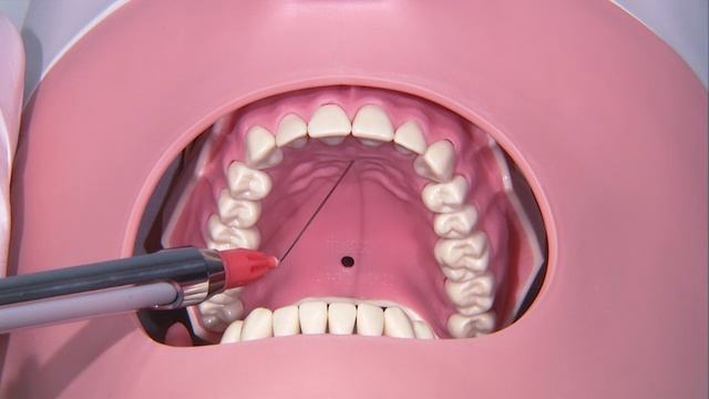 Местная анестезия (3 часть, проводниковая анестезия носонебного нерва на уровне резцового отверстия)