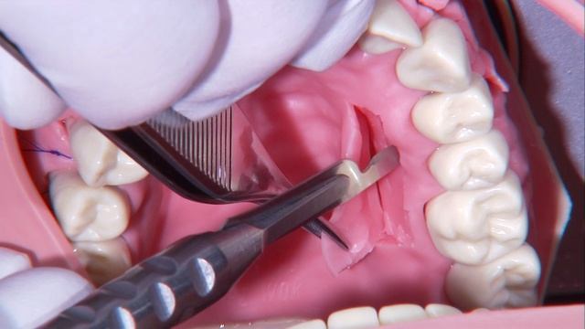 Пластическая хирургия пародонта (10 часть, забор соединительнотканного трансплантата)