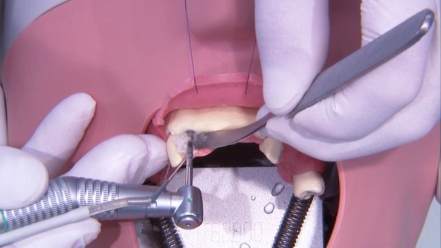 Имплантология (7 часть, пилотный участок 1)