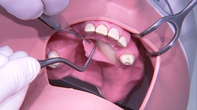 Оперативное удаление ретенированного клыка (2 часть, подъем закрылок)