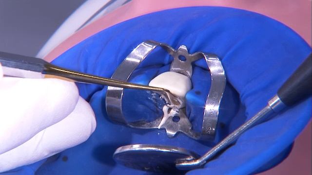 Эндодонтия (13 часть, временная пломба ватой и цементом)