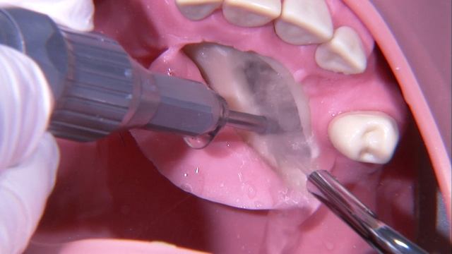 Оперативное удаление (10 часть, одонтотомия с использованием фрезы Линдемана, дистальная)