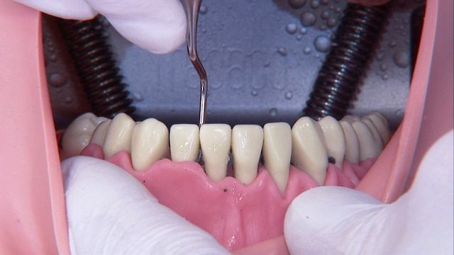 Удаление зубного камня (6 часть, кюретаж)