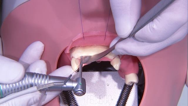 Имплантология (6 часть, точечное сверление (для разметки места имплантации))