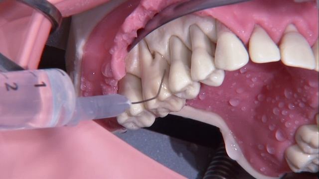 Пародонтальная хирургия (10 часть, промывание антисептиком)