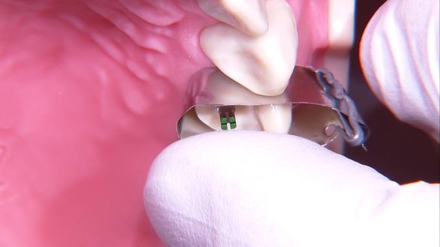 Восстановление культи зуба (9 часть, закрепление и затягивание стальной матрицы)