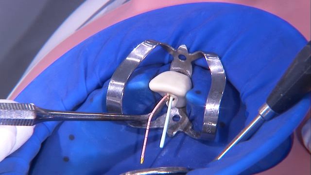 Эндодонтия (10 часть, нагревание гуттаперчевых штифтов)