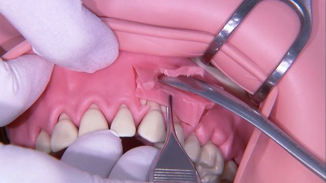 Пластическая хирургия пародонта (12 часть, размещение трансплантата в место реципиента)