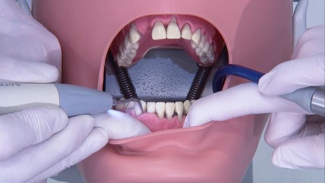 Удаление зубного камня (5 часть, ультразвуковая чистка зубов)