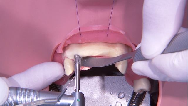 Имплантология (12 часть, профилированная подготовка участка BL (уровень кости))