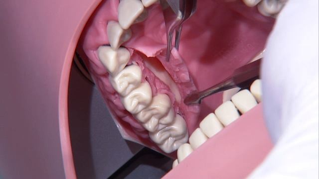 Пародонтальная хирургия (4 часть, поднятие лоскута, небного)