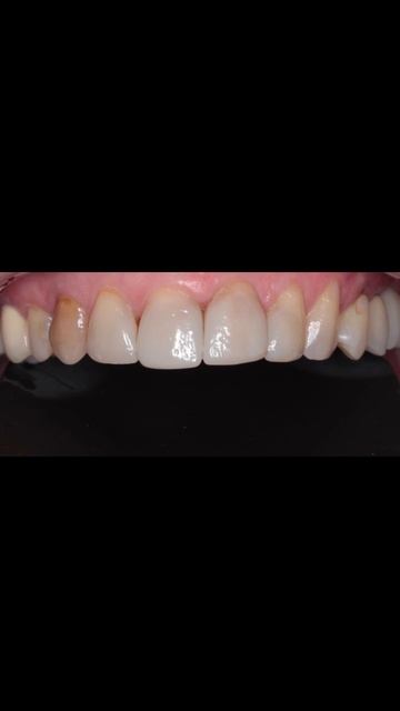 До и после, в которое хочется улыбнуться 😊 #протезирование #новаяулыбка #стоматология #доипосле