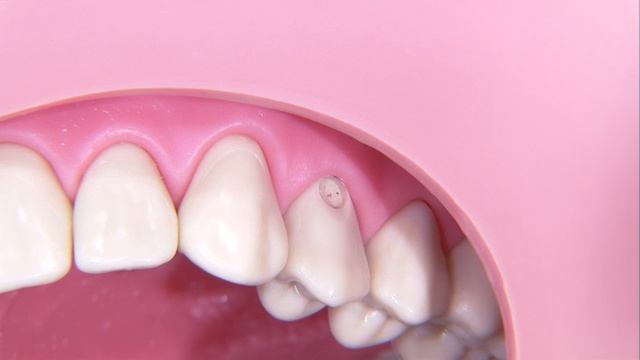 Восстановление шейки зуба (3 часть, препарирование полости с помощью эмалевого скоса)