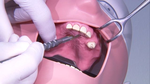 Оперативное удаление ретенированного клыка (1 часть, разрез)