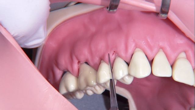 Пародонтальная хирургия (2 часть, поднятие лоскута, щечный)