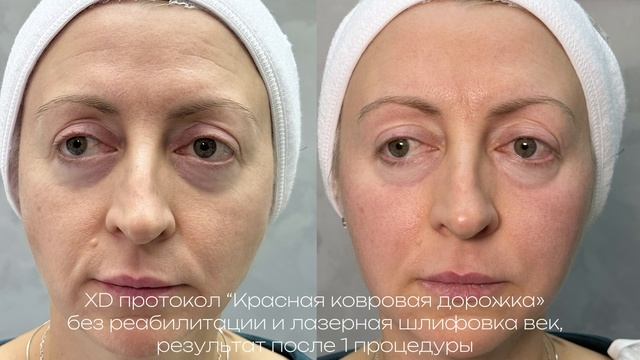 Процедуры Vydence До и После в I-FEEL MEDICAL RESORT  (Вайденс До и После в Айфил Медикал Резорт).