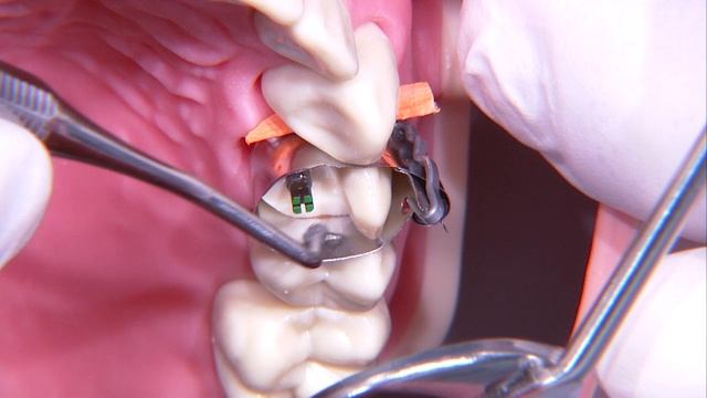 Восстановление культи зуба (11 часть, полировка)