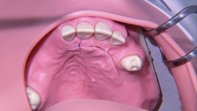 Оперативное удаление ретенированного клыка (12 часть, закрытие раны)