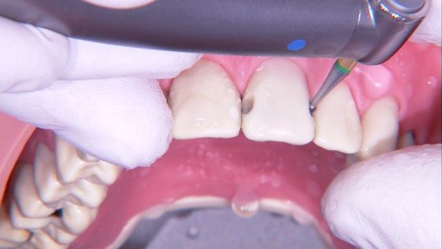 Реставрация передних зубов (2 часть, удаление кариеса)