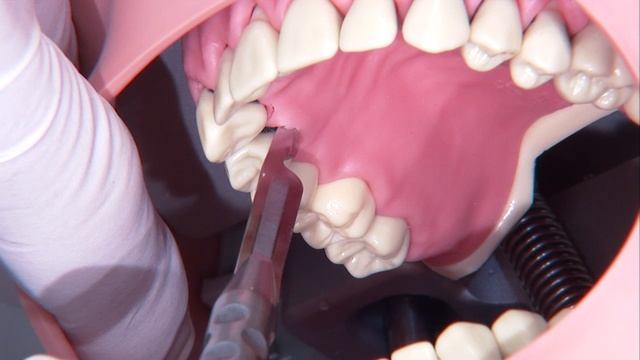 Пародонтальная хирургия (3 часть, разрез небный)