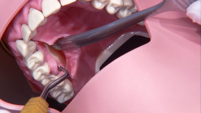 Пародонтальная хирургия (5 часть, удаление зернистой ткани, небной)