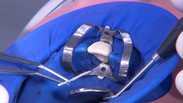 Эндодонтия (9 часть, фиксация цементом и гуттаперчей)