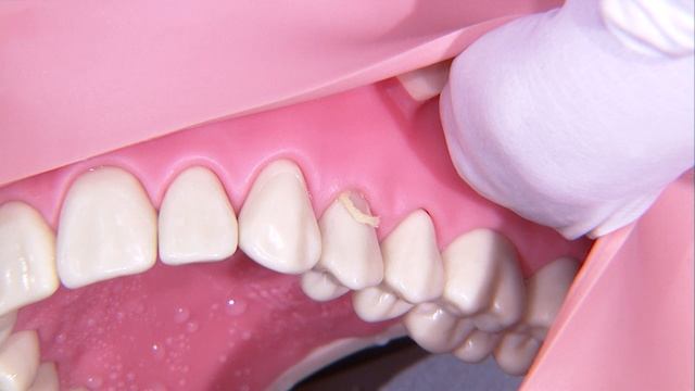 Восстановление шейки зуба (9 часть, извлечение ретракционных шнуров)