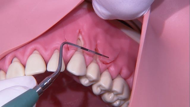 Пластическая хирургия пародонта (7 часть, определение размера трансплантата)