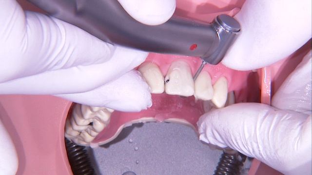 Реставрация передних зубов (1 часть, подготовка полости)