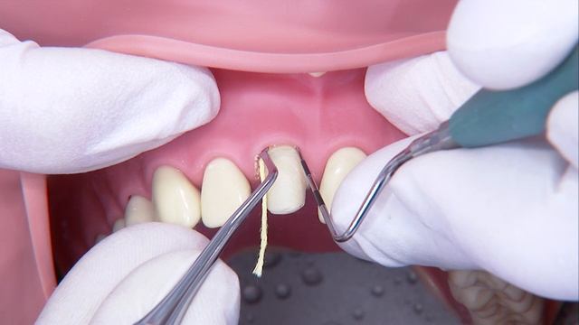 Ретракция десны и получение окончательного оттиска (1 часть, наложение ретракционной нити)